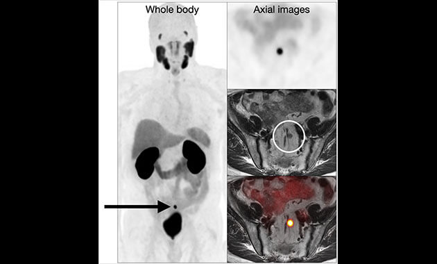 PSMA PET CT Scan — Complete Patient Guide | EVE Healthcare