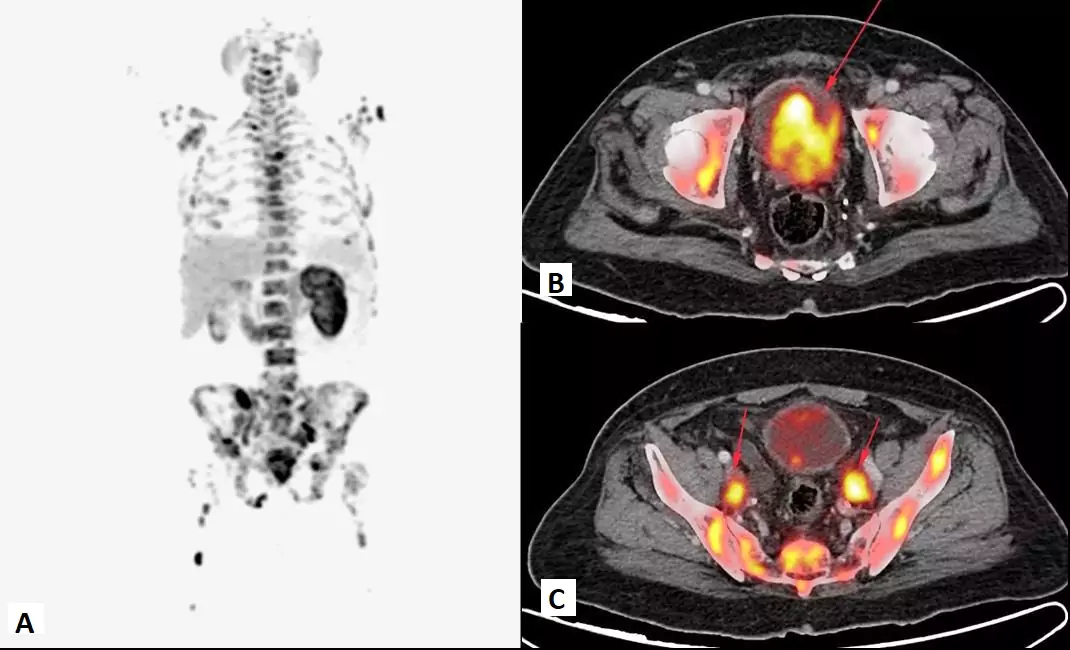 PSMA PET CT Scan — Complete Patient Guide | EVE Healthcare